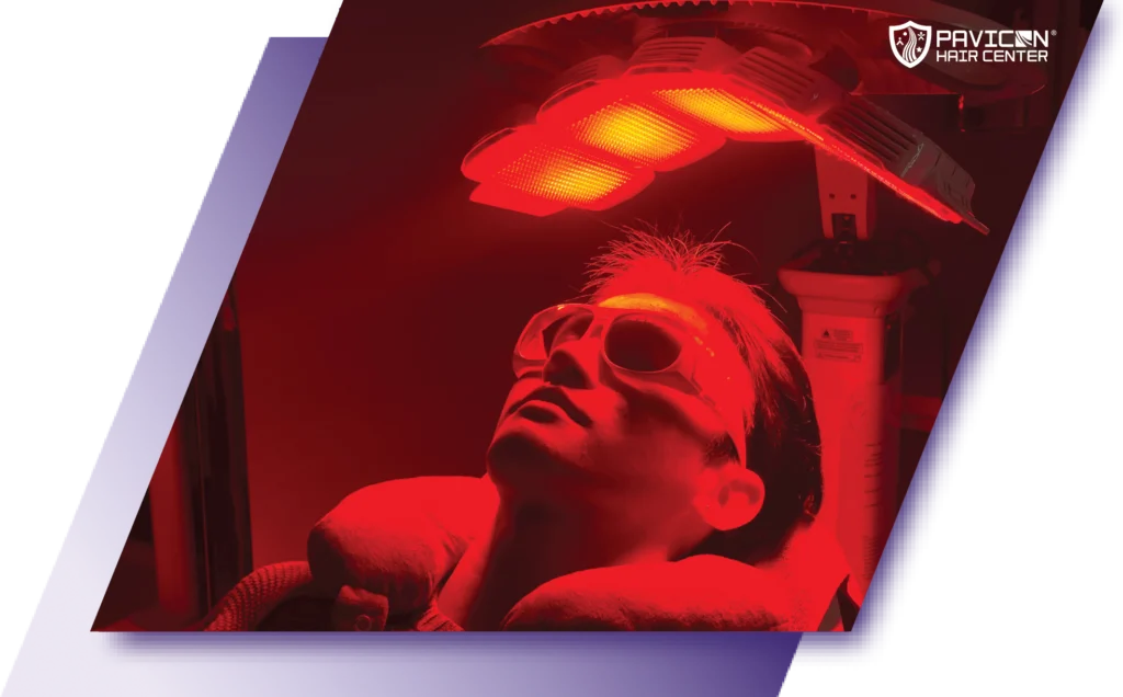 Hair Laser Therapy ( LLLT ) - EN - paviconclinic.com
